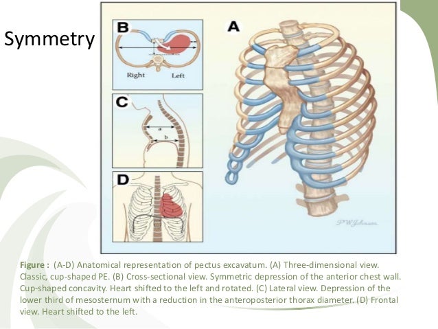 Congenital Chest Wall Abnormality