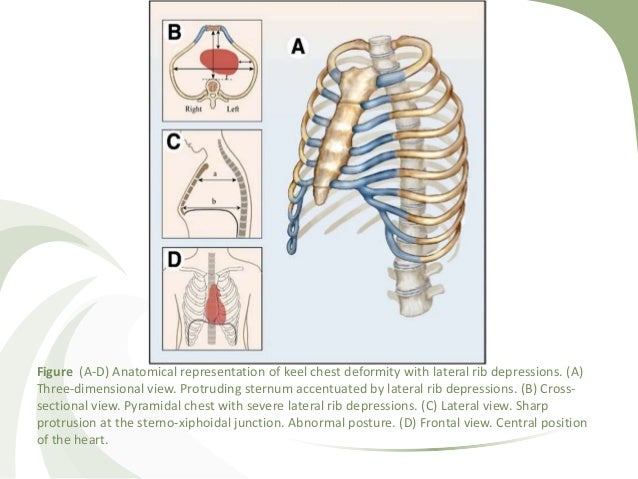Chest Wall Abnormality