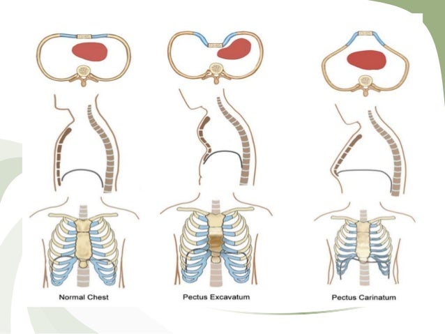 Congenital Chest Wall Abnormality