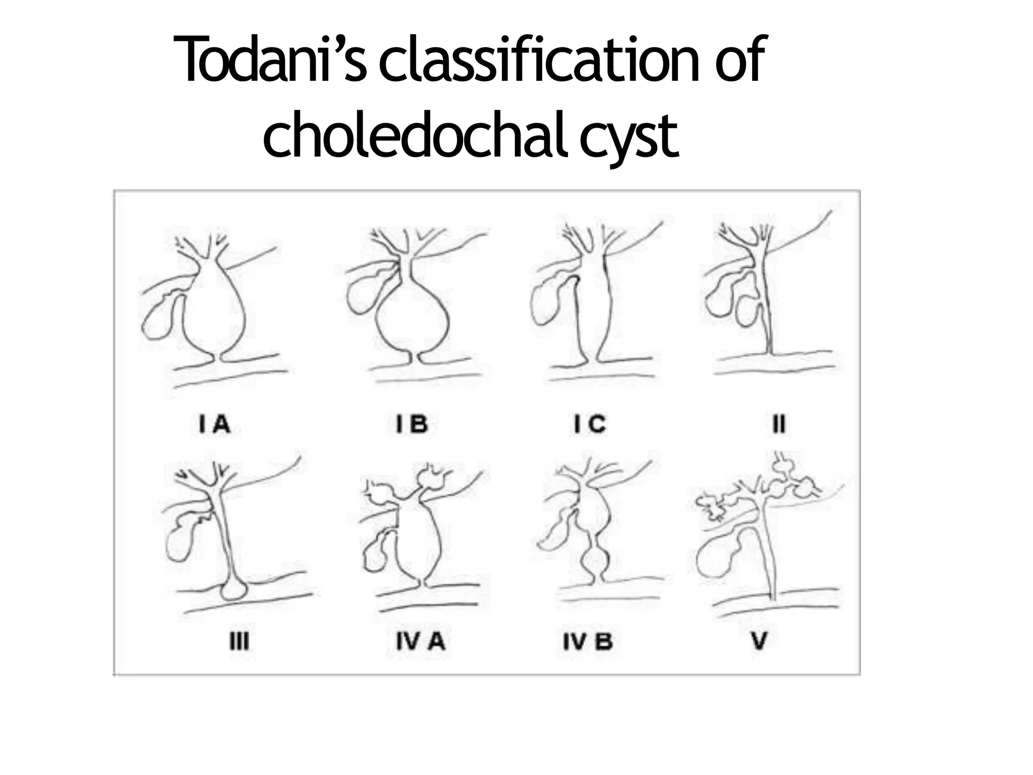 Final choledochal cyst | PPTX