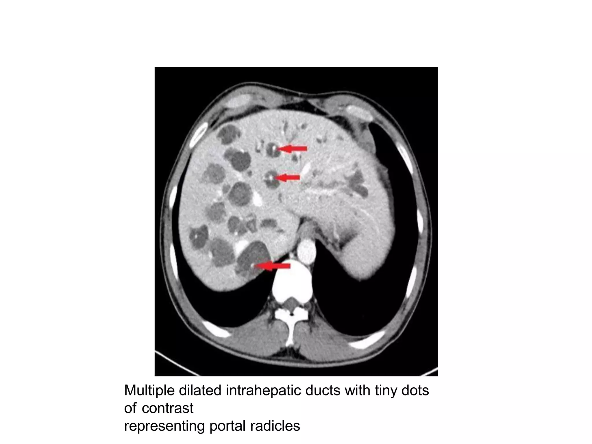 Final choledochal cyst | PPTX