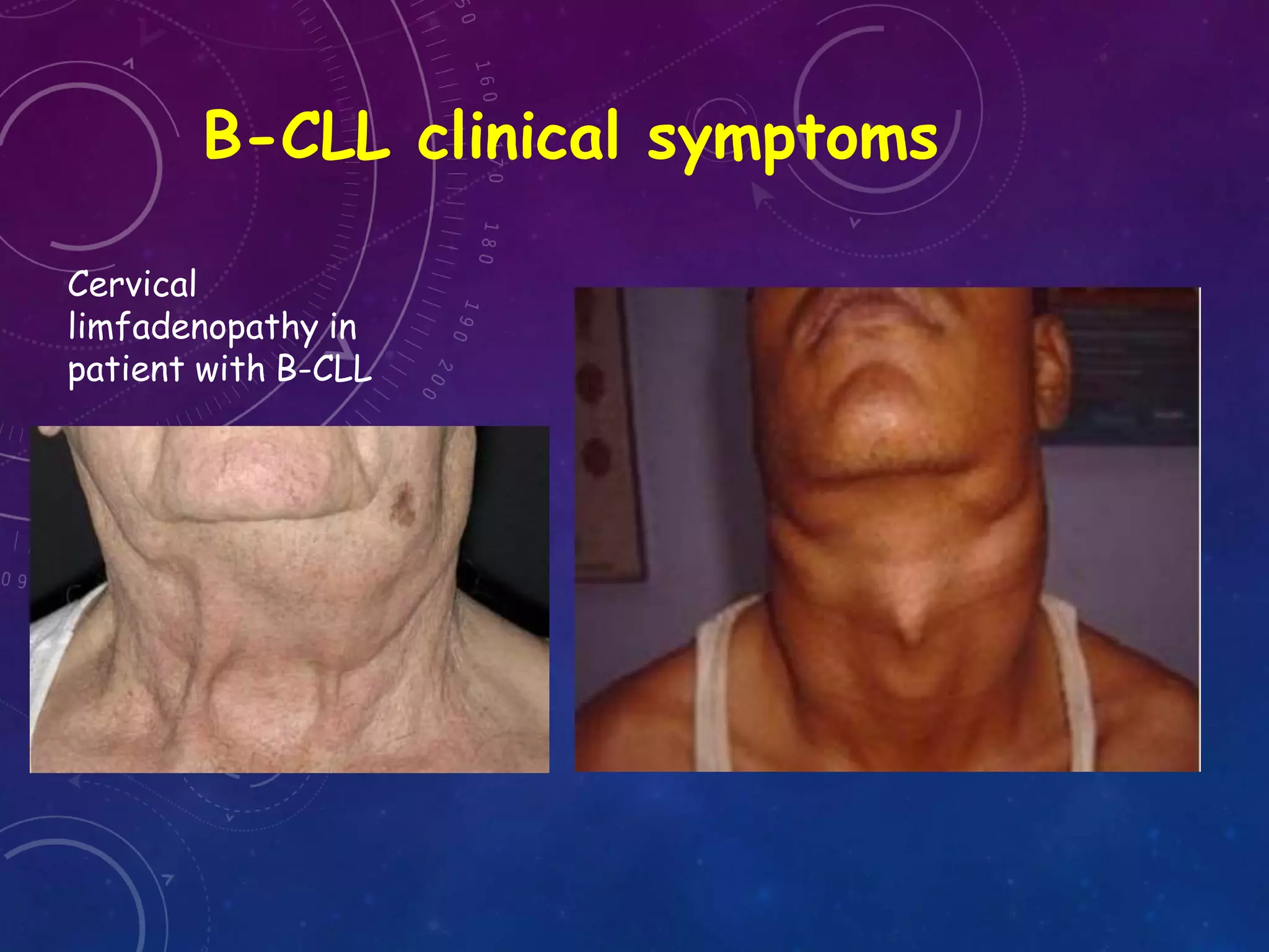 Chronic Lymphocytic Leukemia | PPTX