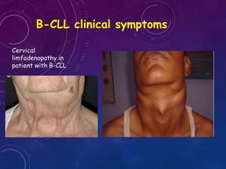 Chronic Lymphocytic Leukemia | PPTX