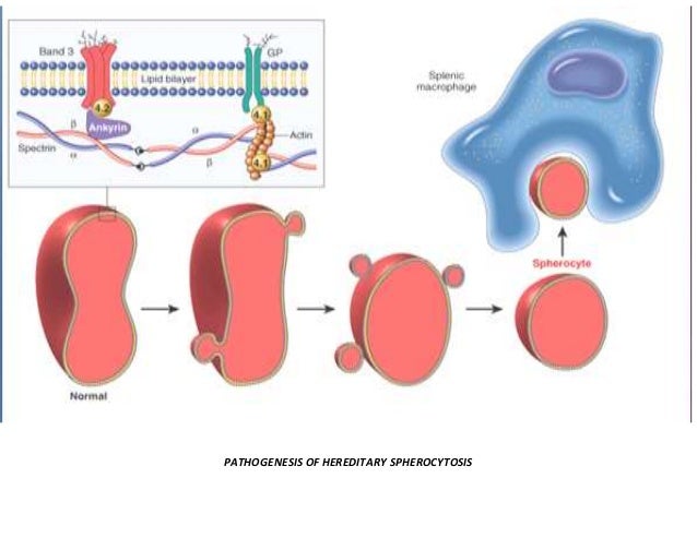 Herditary Spherocytosis – Meddiction
