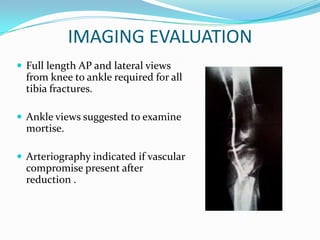 Compound Fracture Tibia | PPTX
