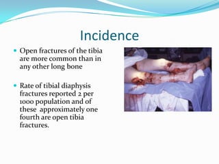 Compound Fracture Tibia | PPTX
