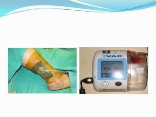Compound Fracture Tibia | PPTX