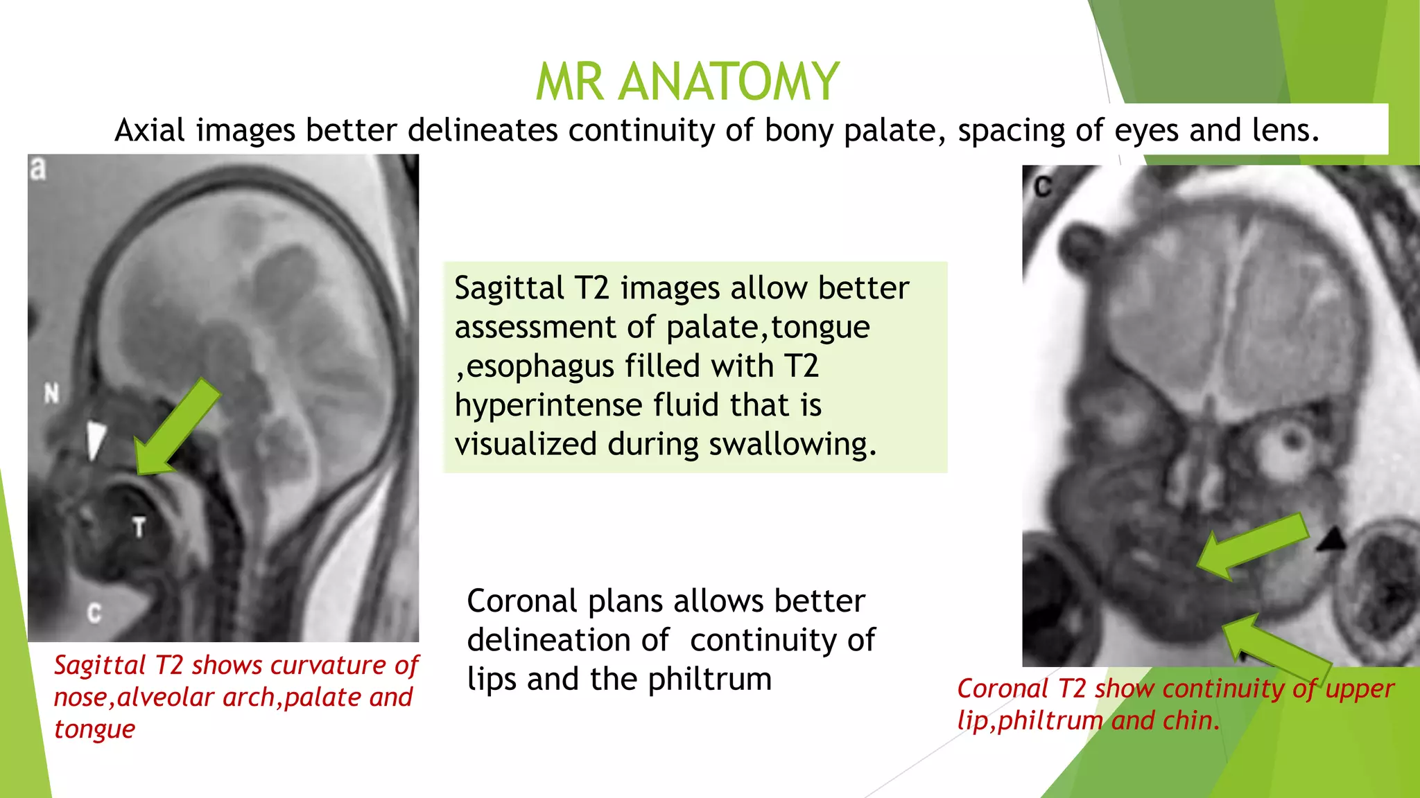 Congenital anomalies of head,neck and face(Radiology) including USG and ...