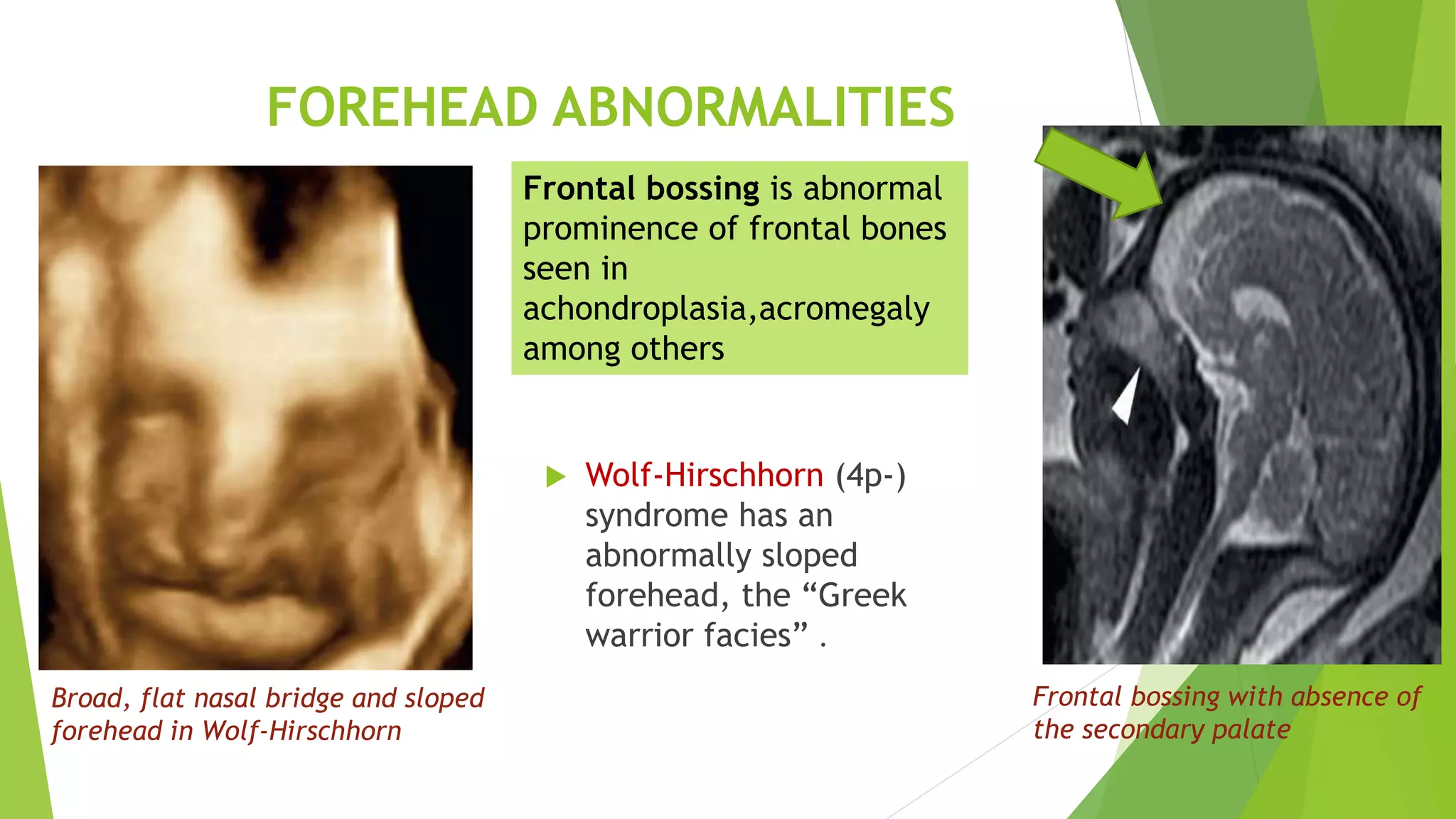 Congenital anomalies of head,neck and face(Radiology) including USG and ...