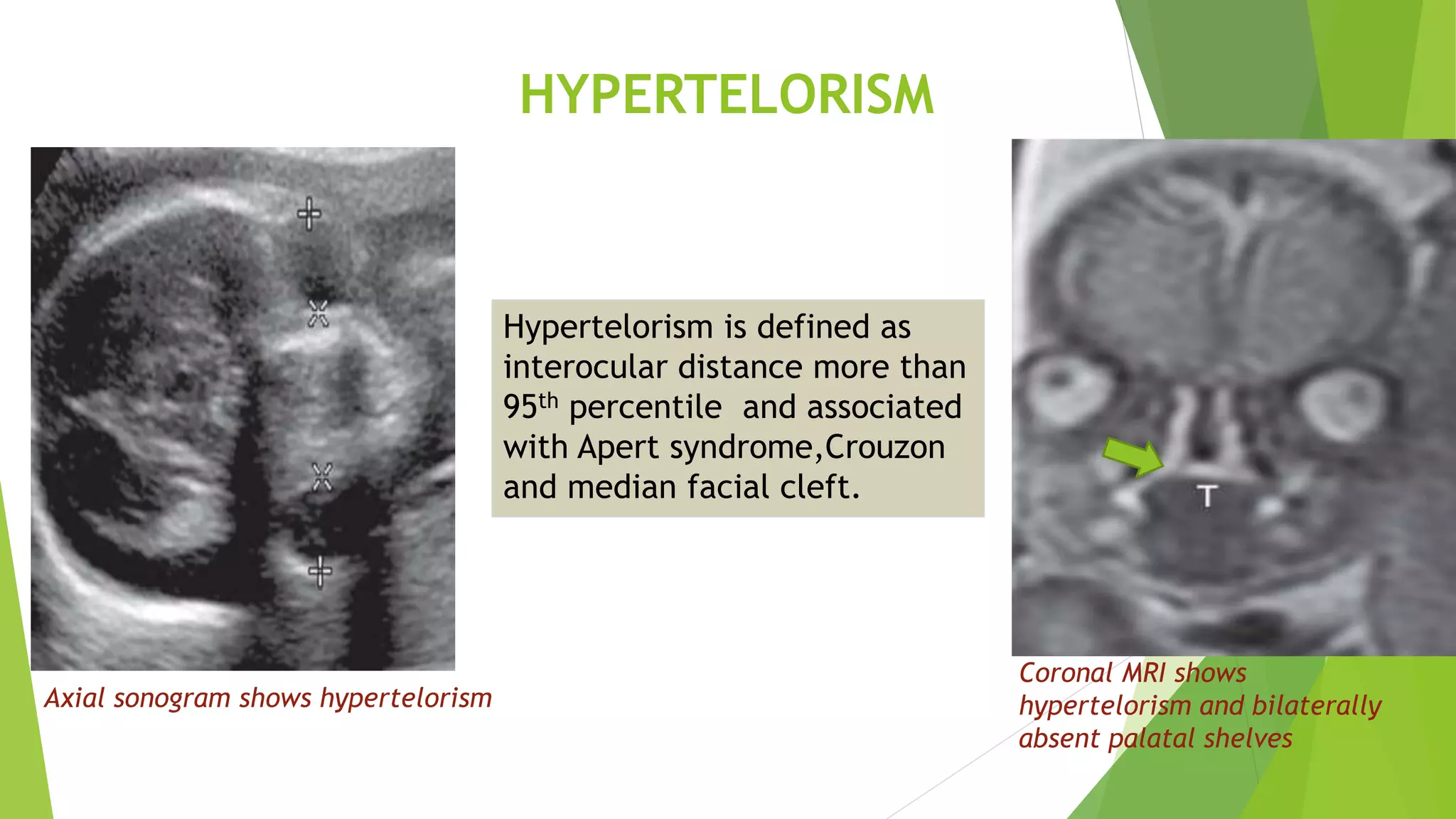 Congenital anomalies of head,neck and face(Radiology) including USG and ...