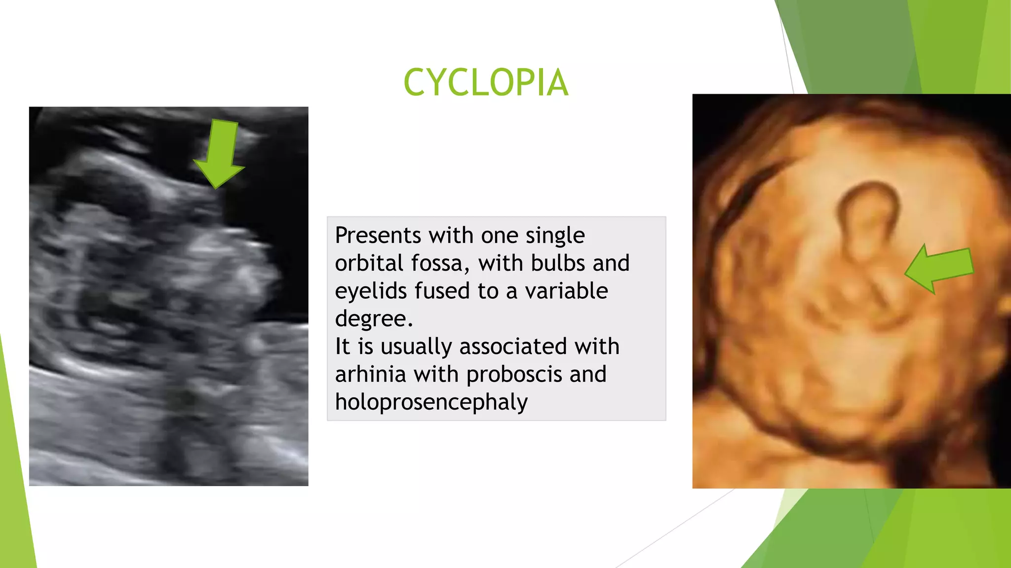 Congenital anomalies of head,neck and face(Radiology) including USG and ...
