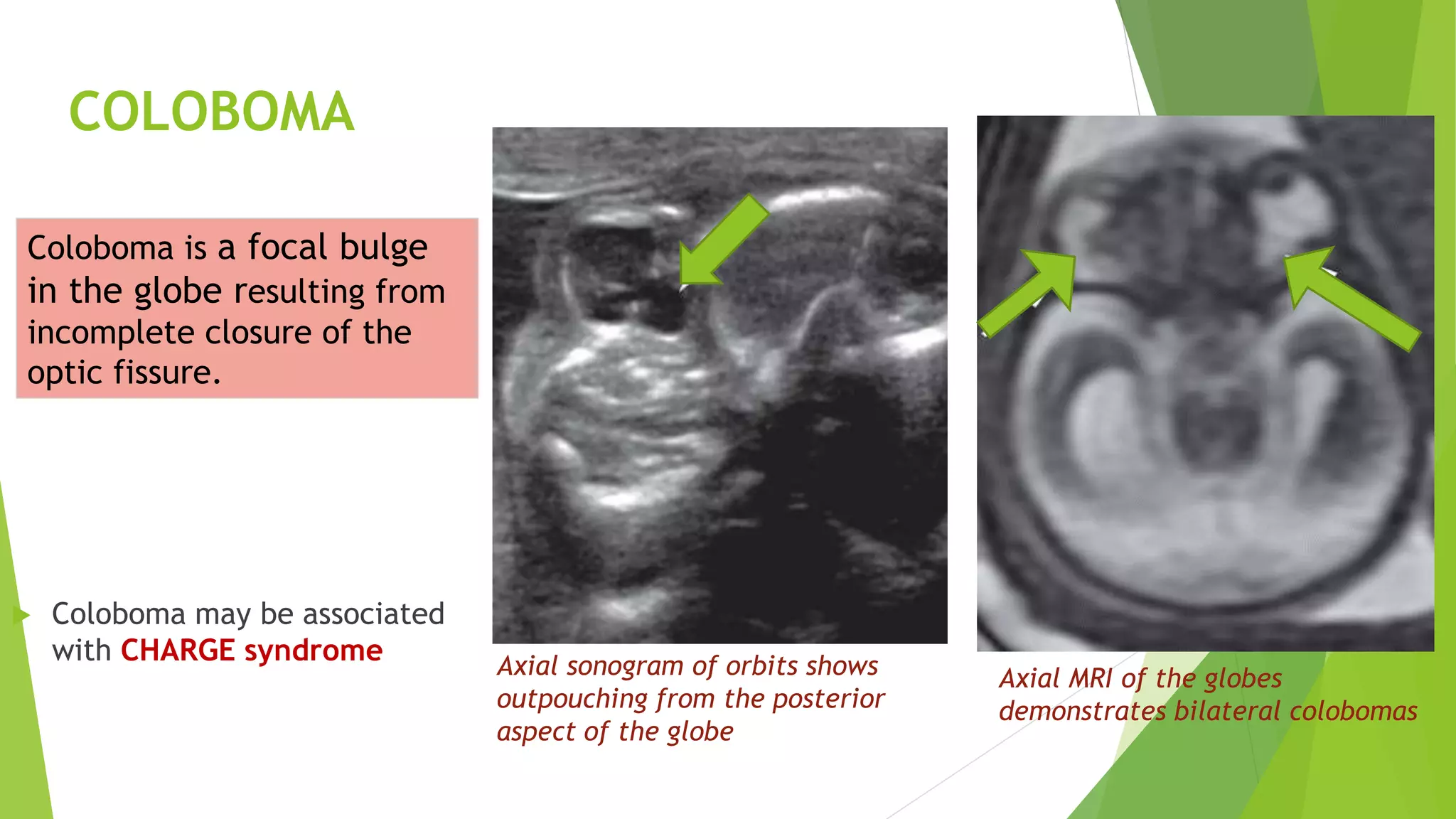 Congenital anomalies of head,neck and face(Radiology) including USG and ...