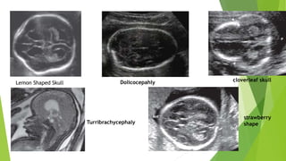 Congenital anomalies of head,neck and face(Radiology) including USG and ...