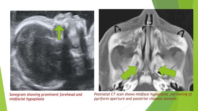 Congenital anomalies of head,neck and face(Radiology) including USG and ...