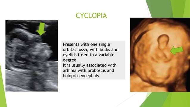 Congenital anomalies of head,neck and face(Radiology) including USG and ...
