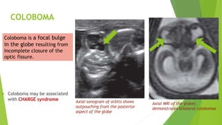 Congenital anomalies of head,neck and face(Radiology) including USG and ...