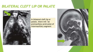 Congenital anomalies of head,neck and face(Radiology) including USG and ...