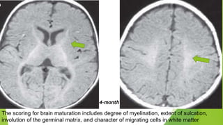 MRI evaluation of developing brain and its role in congenital brain ...