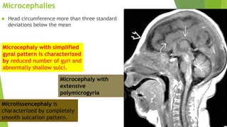 MRI evaluation of developing brain and its role in congenital brain ...