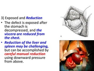 FINAL CONGENITAL DIAPHRAGMATIC HERNIA PPT.pptx