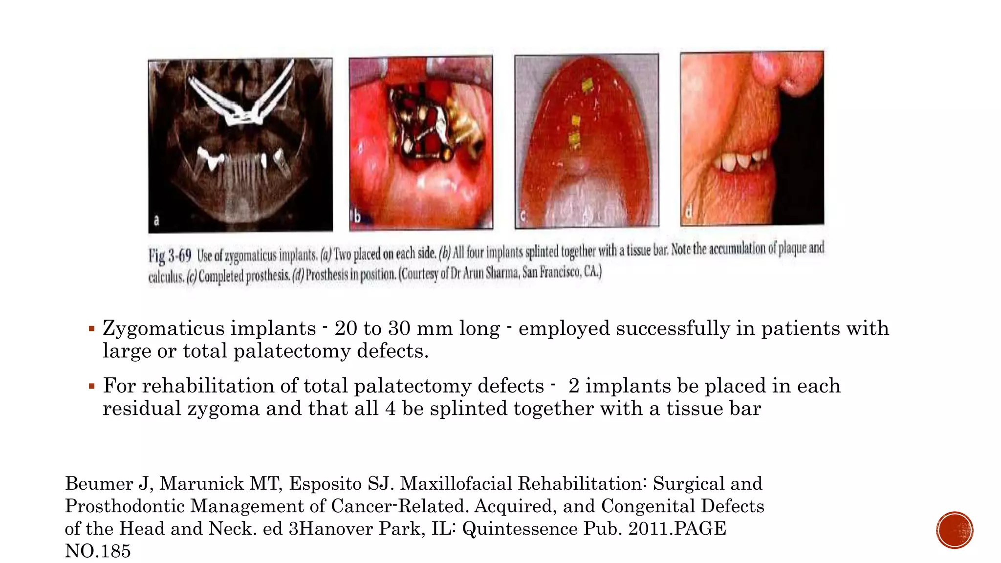 prosthodontic management of maxillectomy/obturators part 2 final copy ...