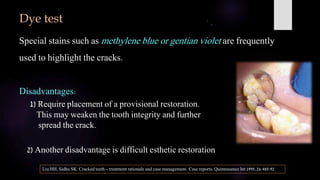 Cracks in Endodontics | PPTX
