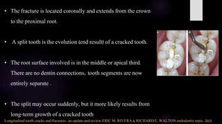 Cracks in Endodontics | PPTX