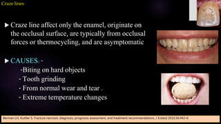 Cracks in Endodontics | PPTX