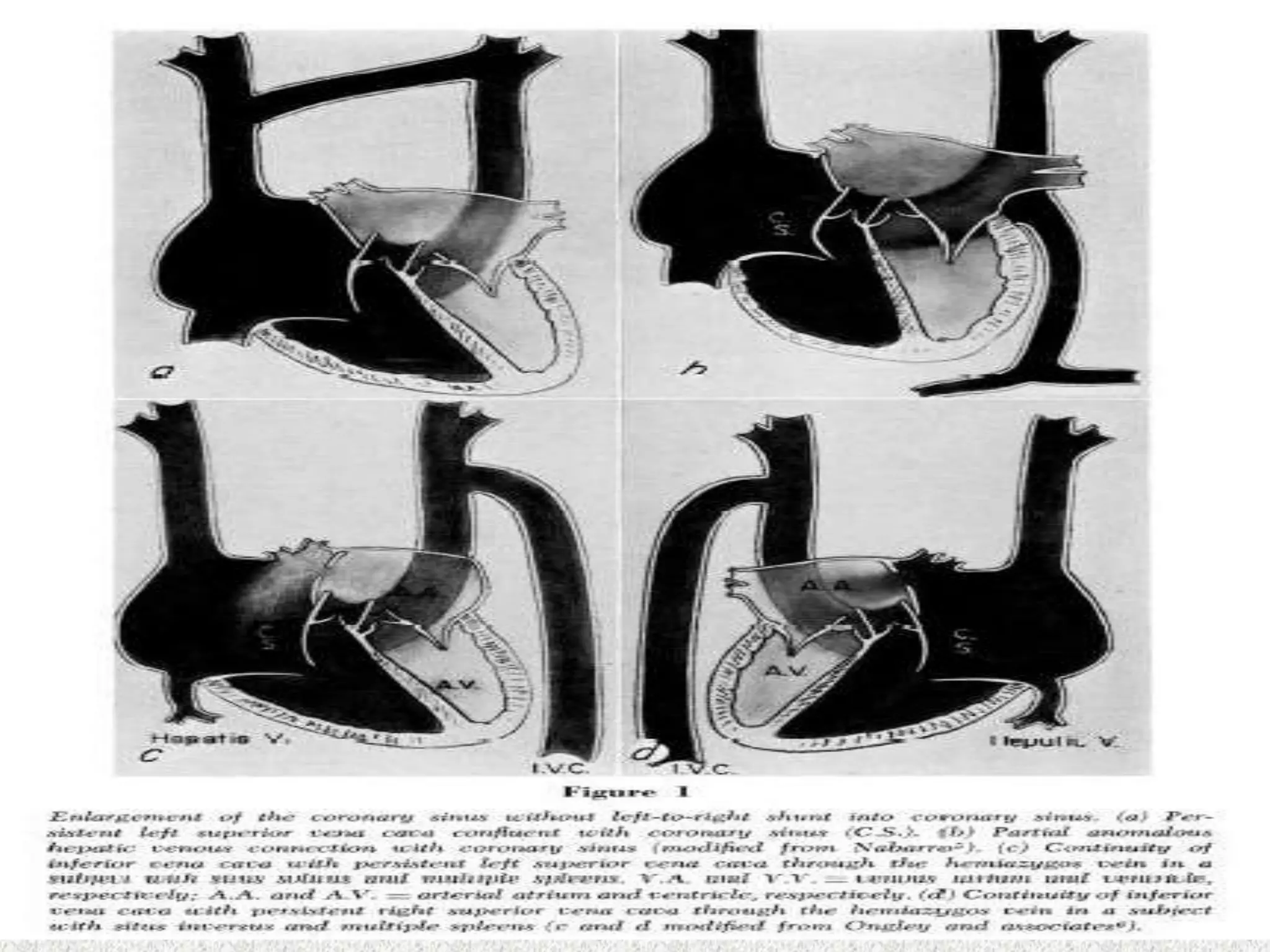 CORONARY SINUS | PPTX