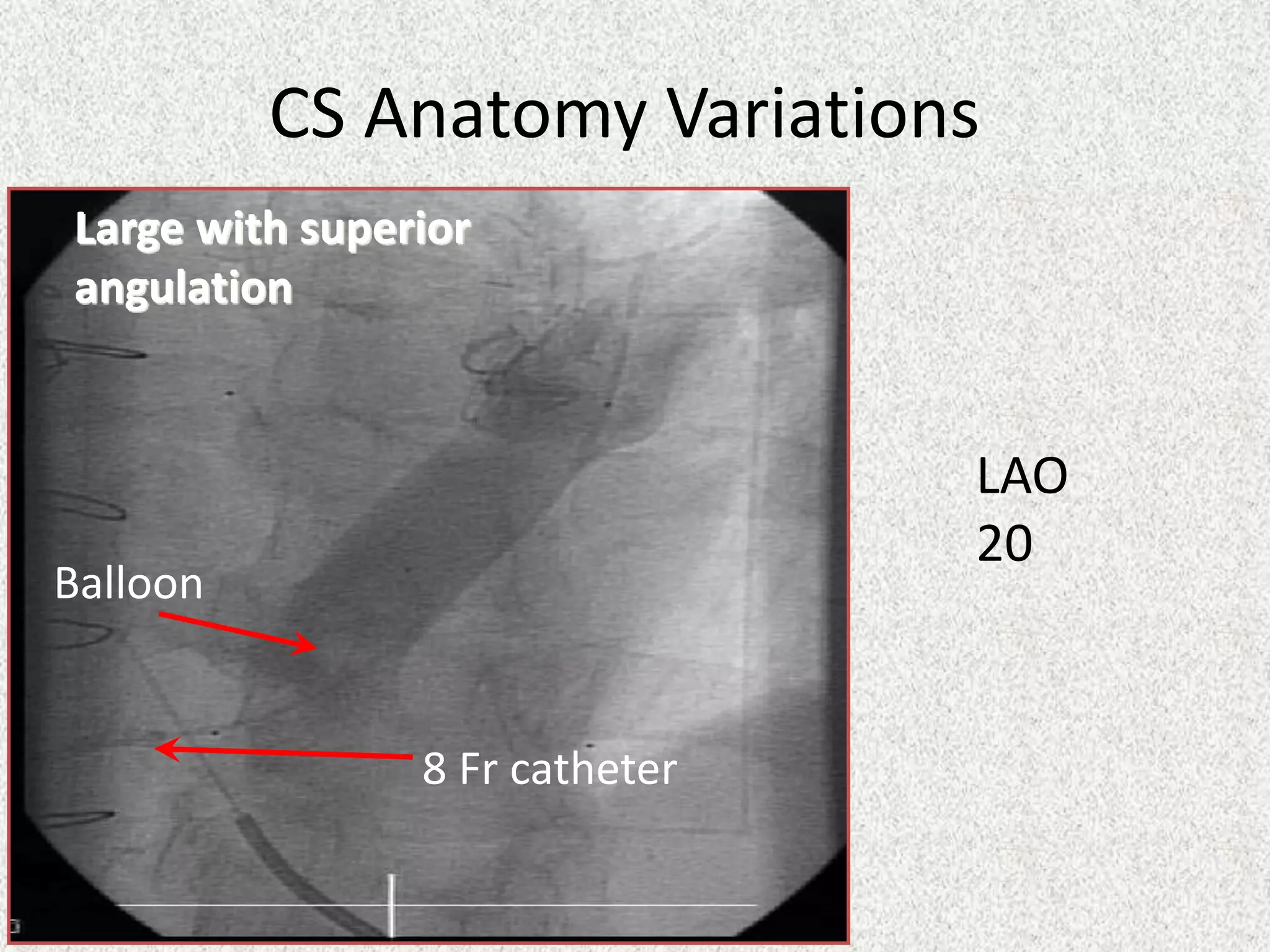 CORONARY SINUS | PPTX