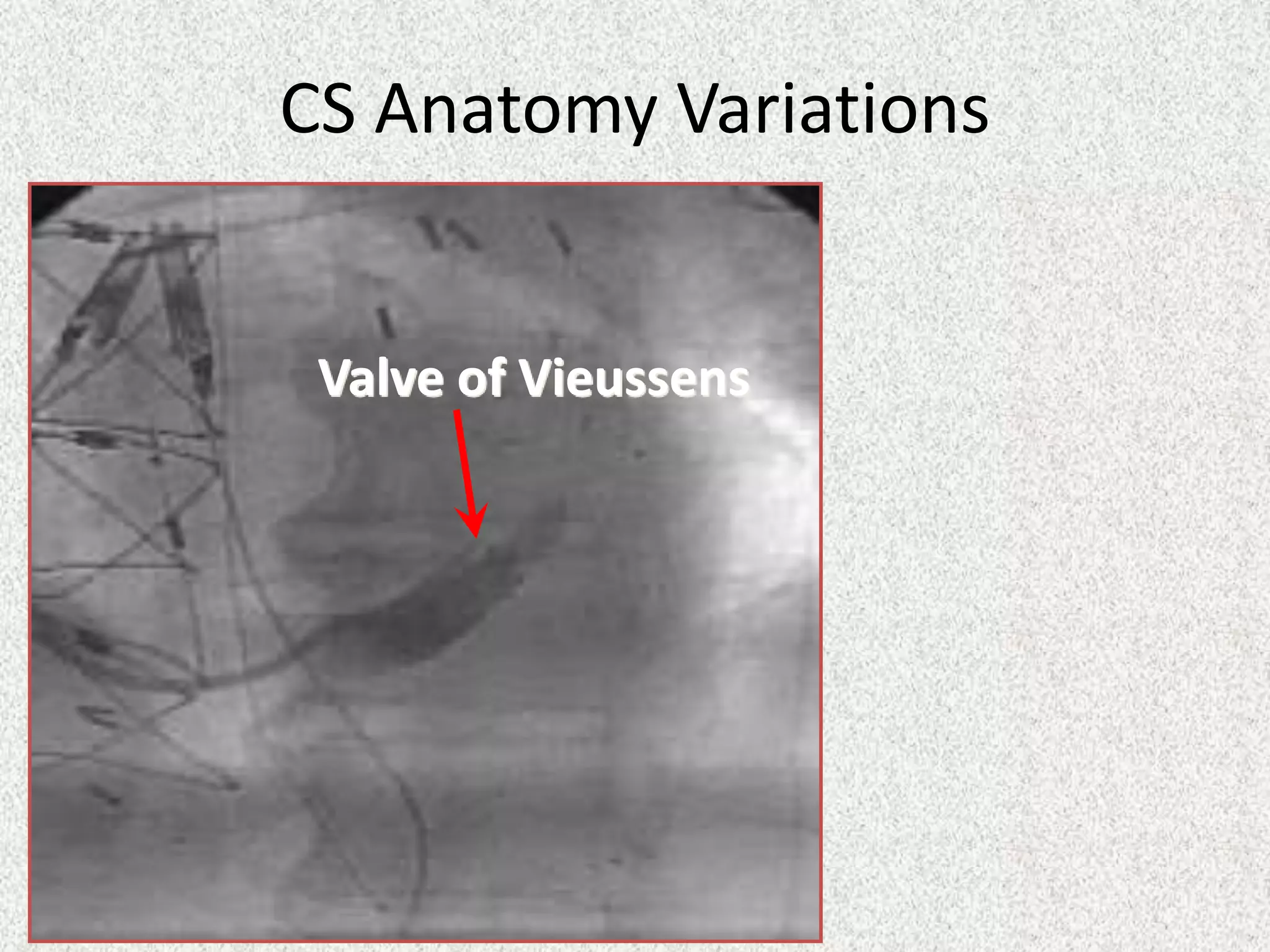 CORONARY SINUS | PPTX