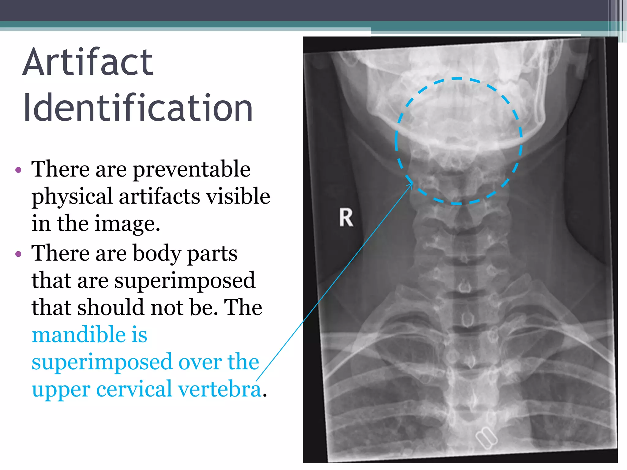 Image Evaluation: AP Axial C-Spine | PPTX