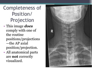 Image Evaluation: AP Axial C-Spine | PPTX