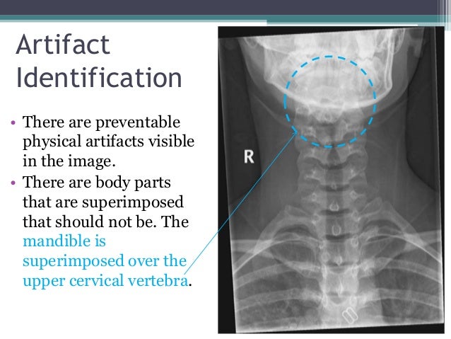 Image Evaluation: AP Axial C-Spine