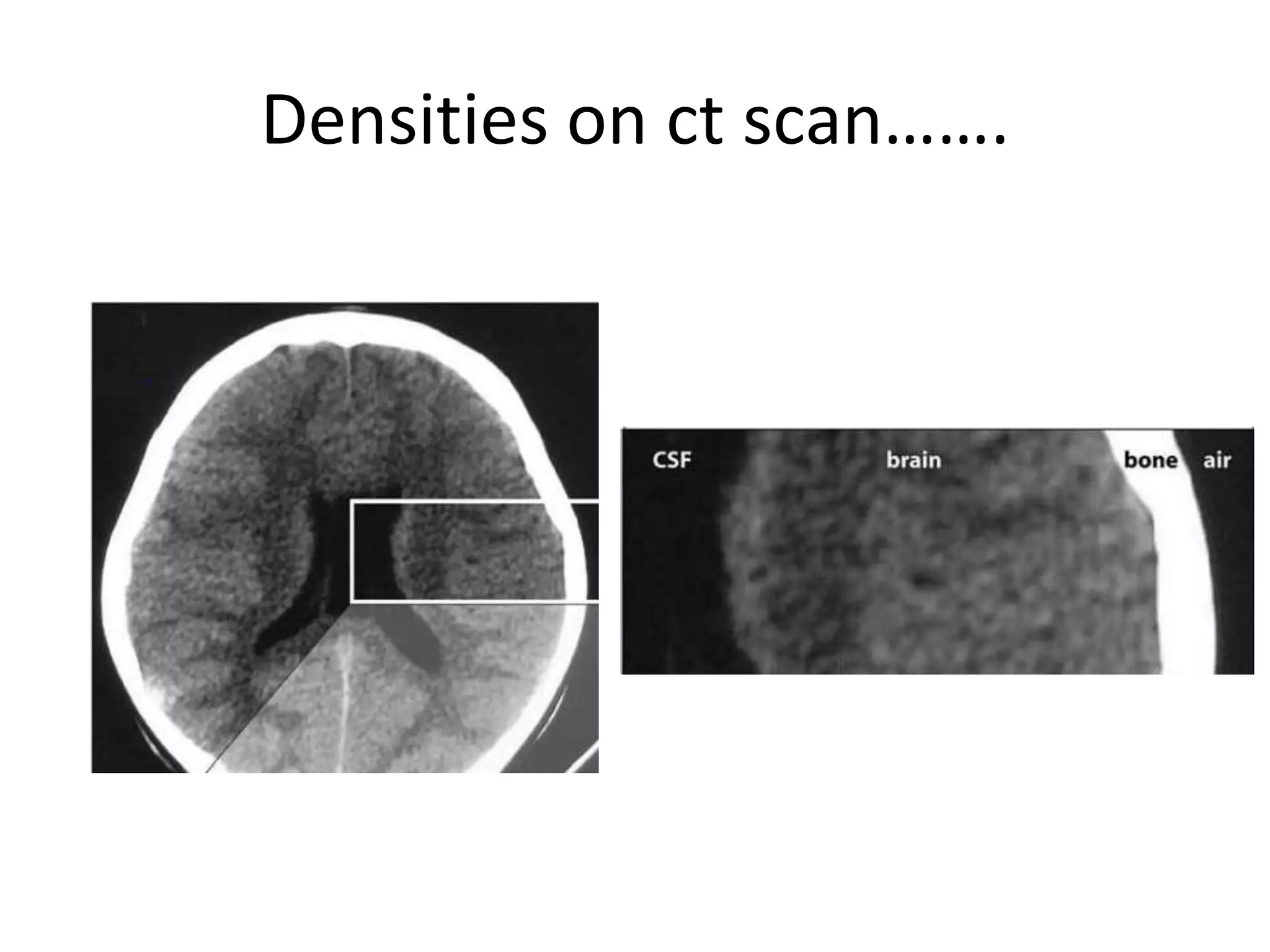 BASICS of CT Head | PPTX