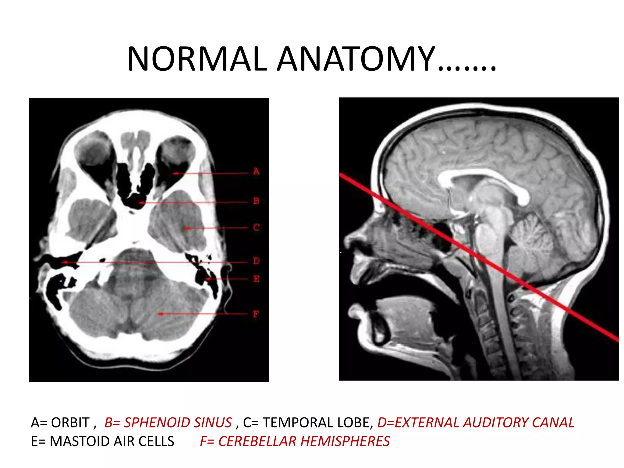 BASICS of CT Head | PPTX
