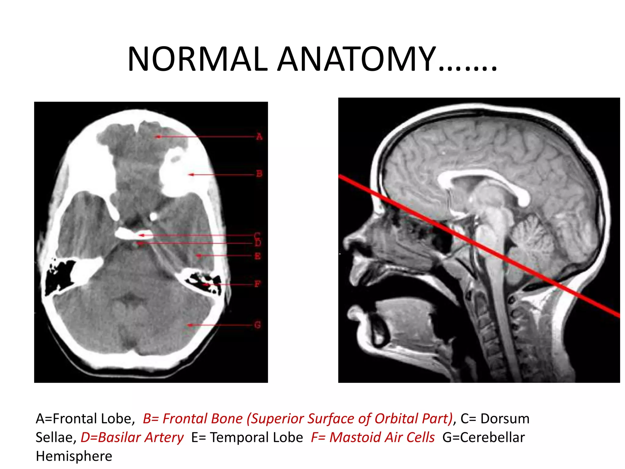 BASICS of CT Head | PPTX
