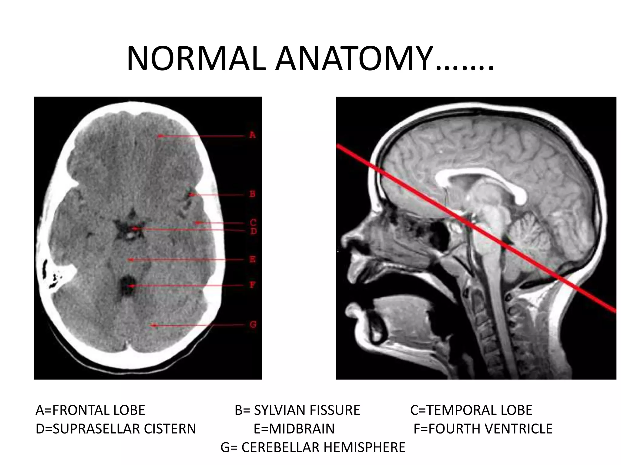 BASICS of CT Head | PPTX