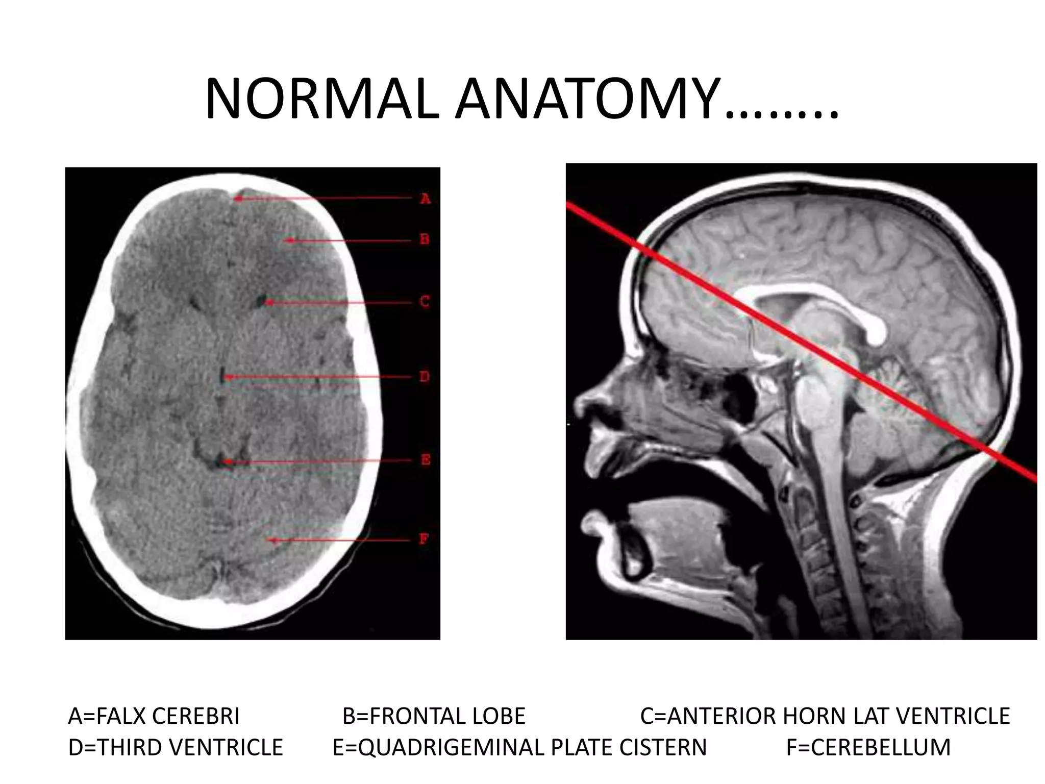 BASICS of CT Head | PPTX
