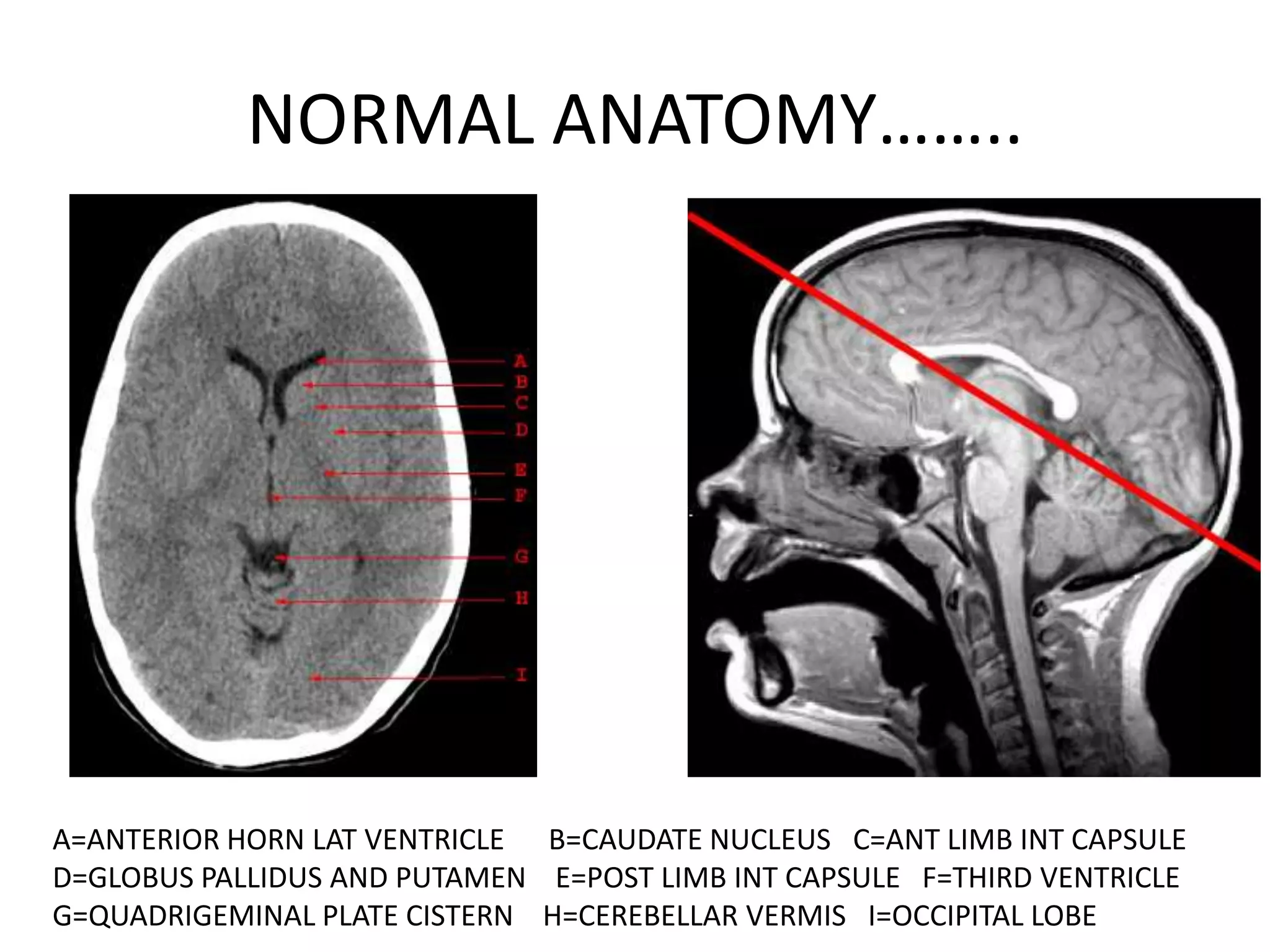 BASICS of CT Head | PPTX