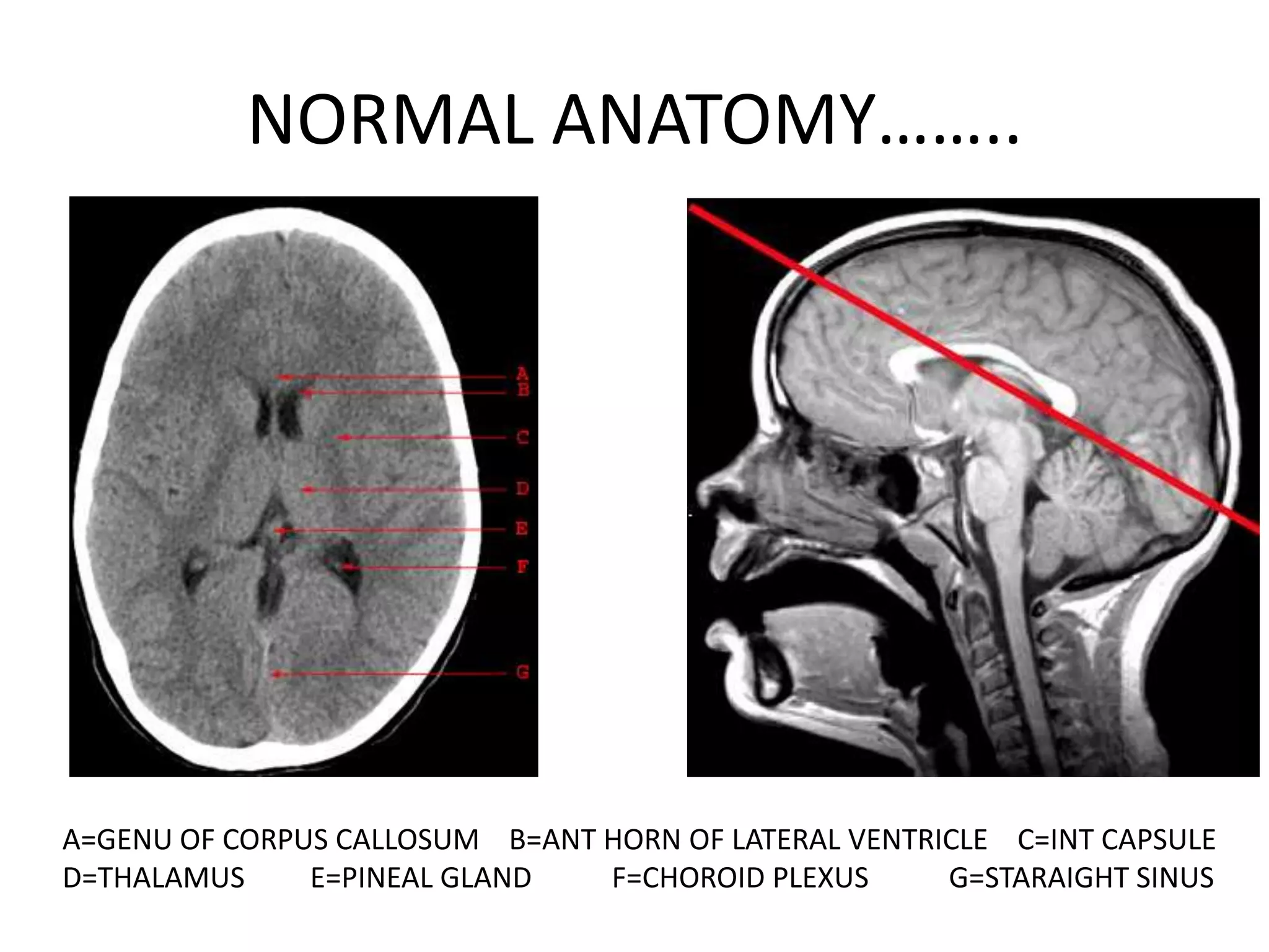 BASICS of CT Head | PPTX