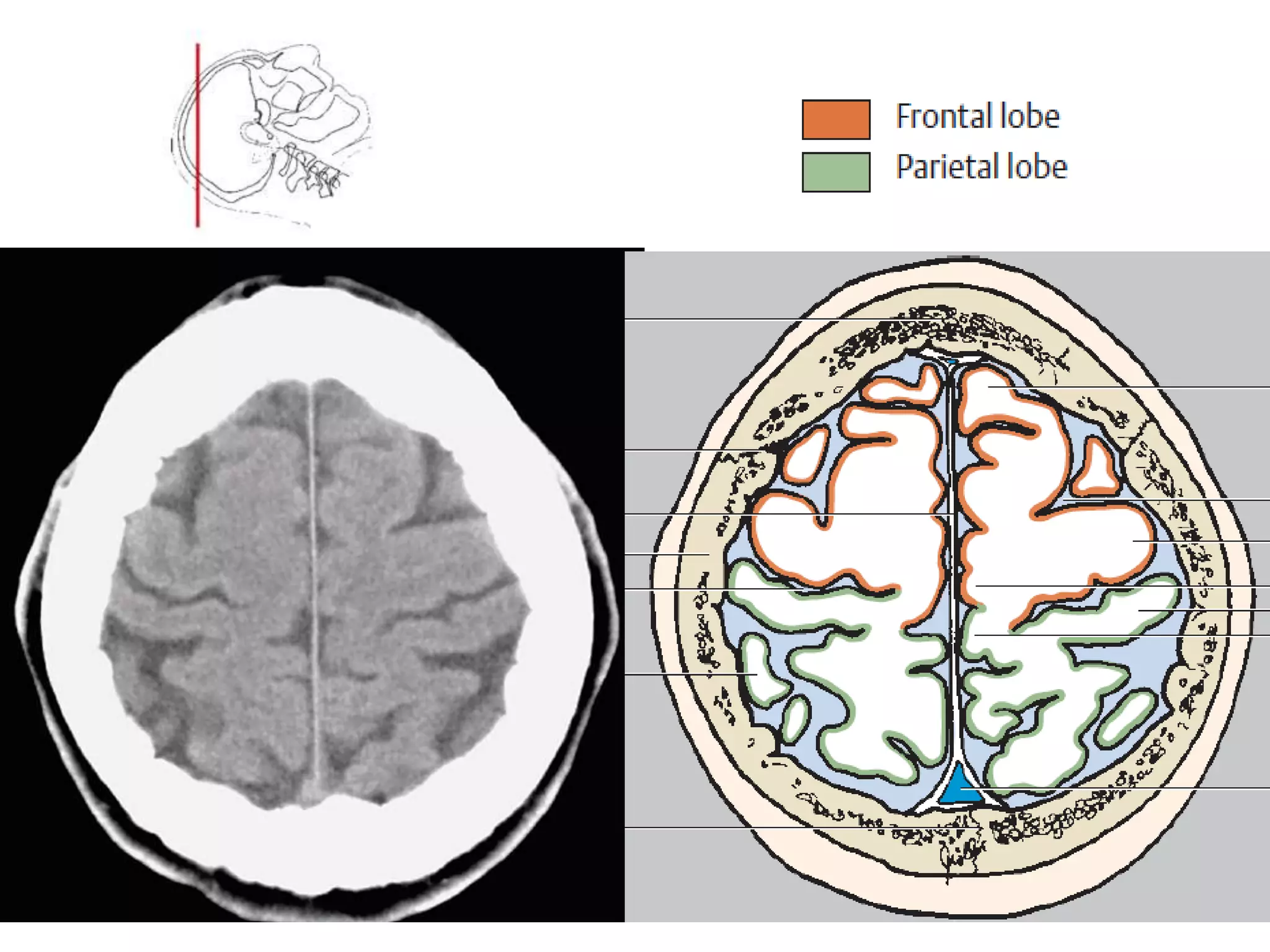 BASICS of CT Head | PPTX