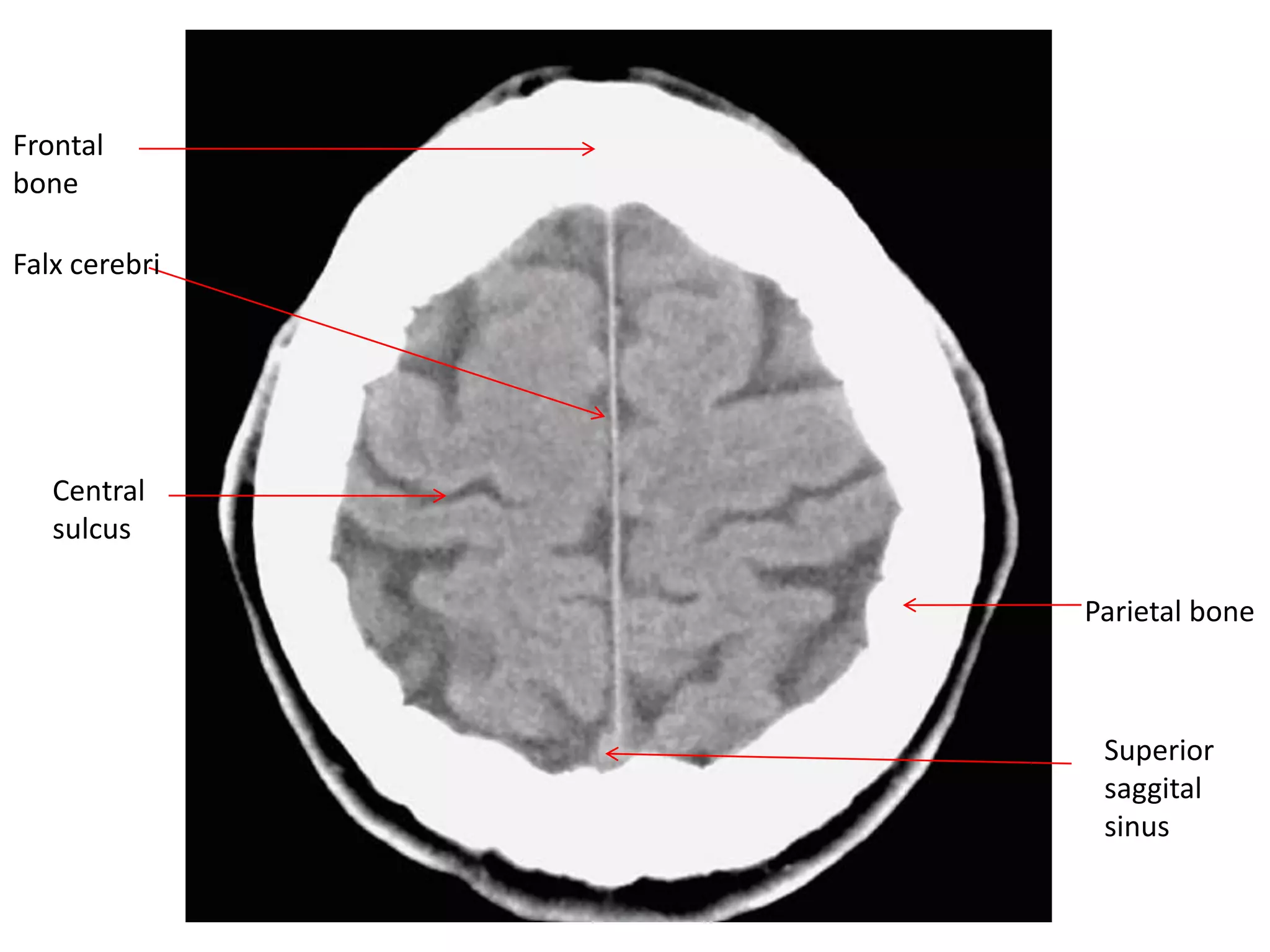 BASICS of CT Head | PPTX