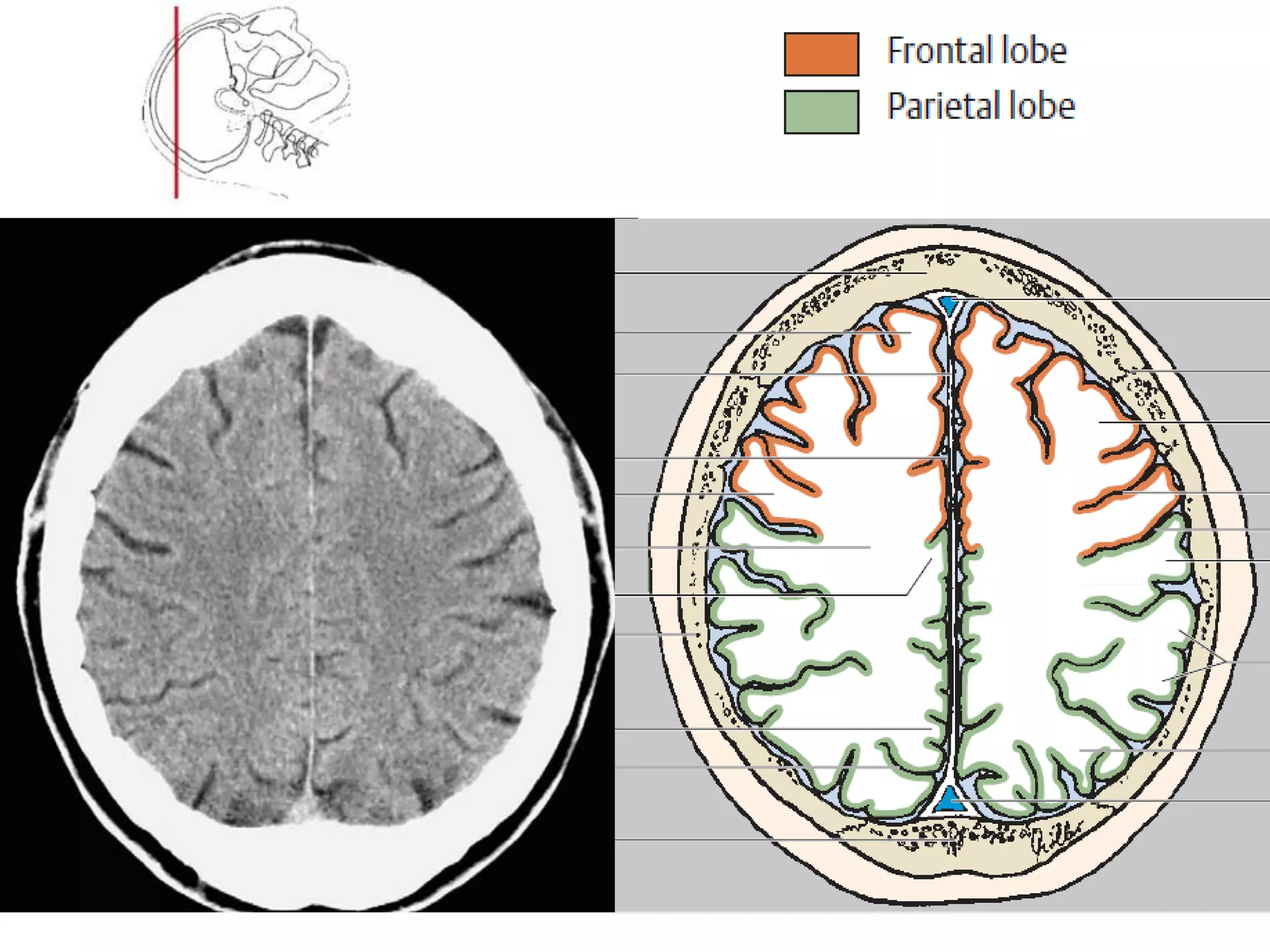 BASICS of CT Head | PPTX