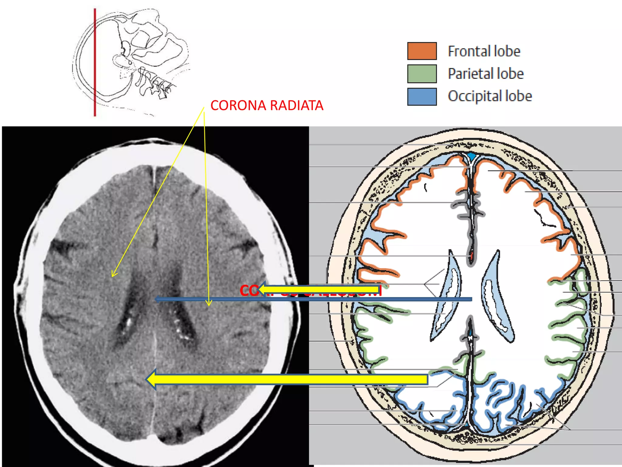 BASICS of CT Head | PPTX
