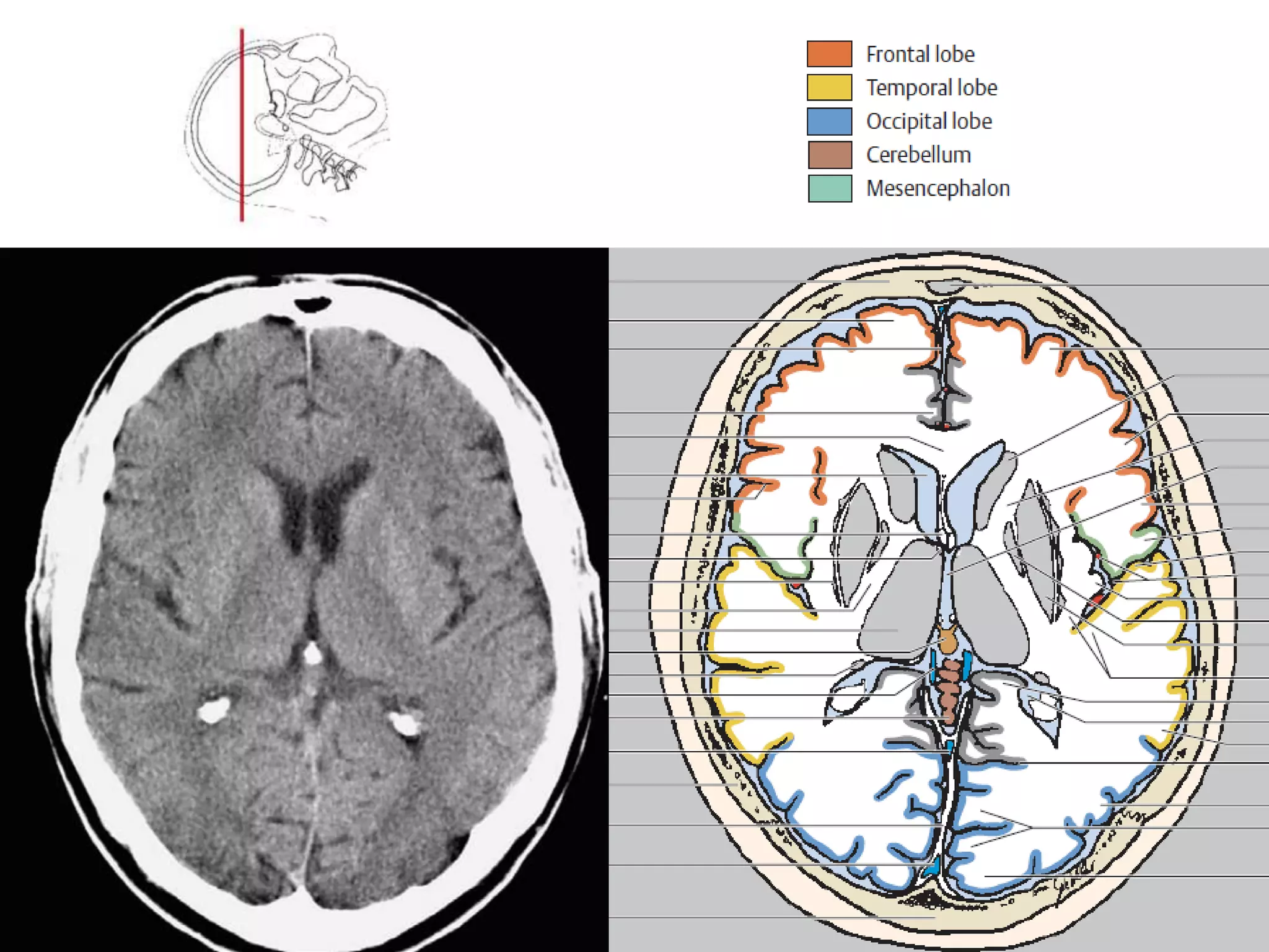 BASICS of CT Head | PPTX