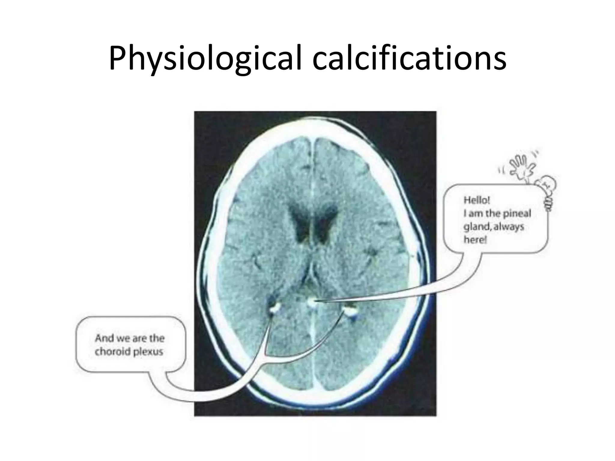 BASICS of CT Head | PPTX