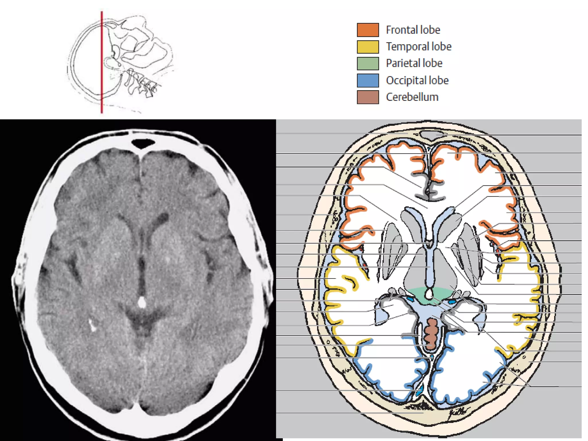 BASICS of CT Head | PPTX
