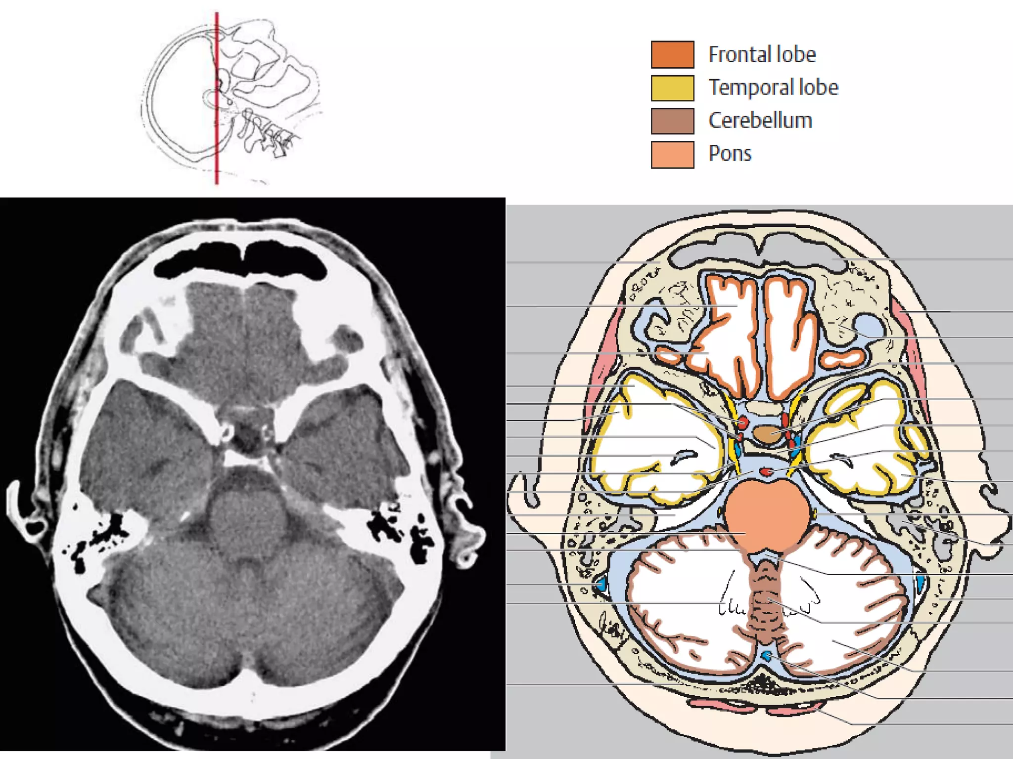 BASICS of CT Head | PPTX