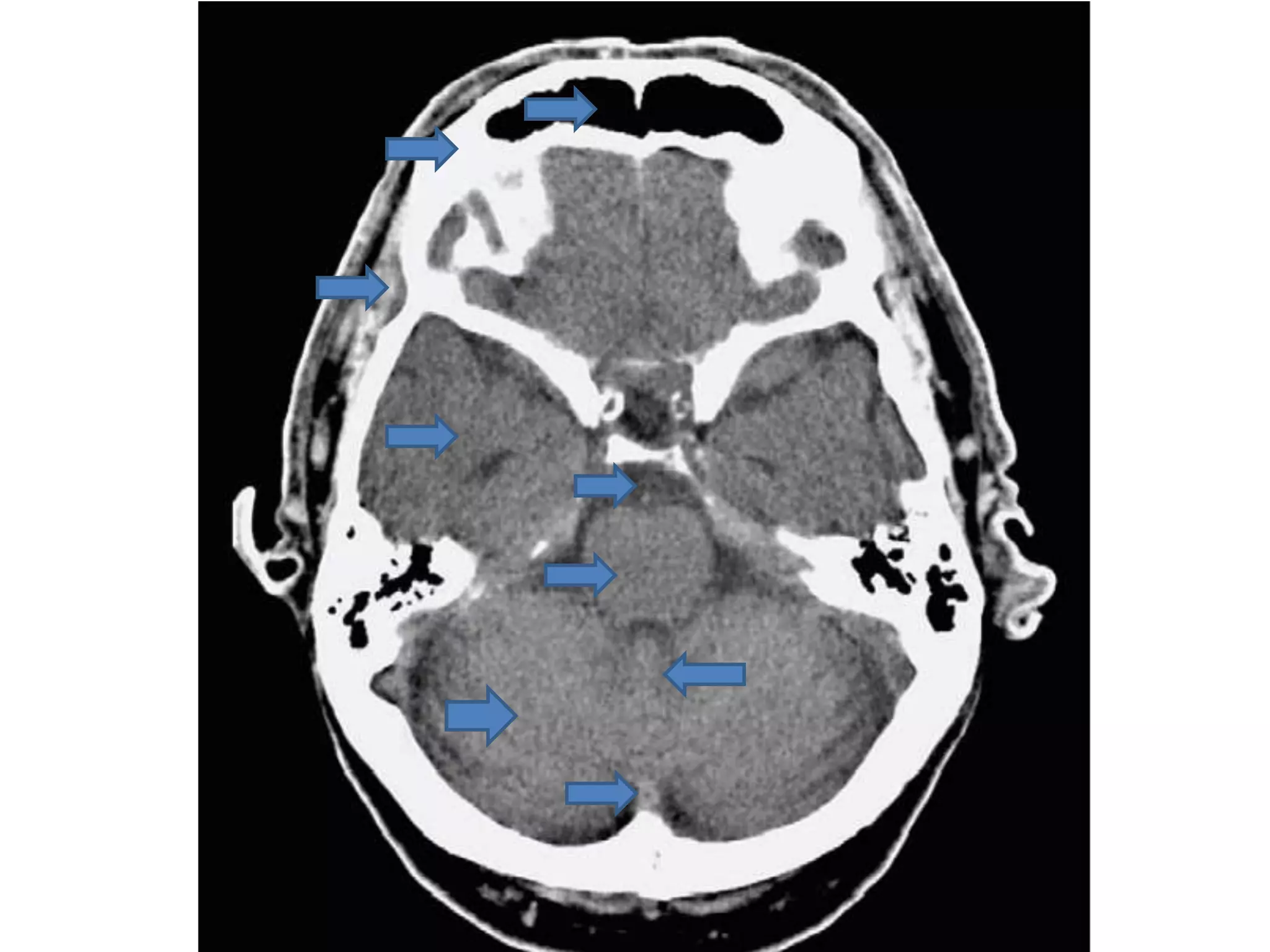 BASICS of CT Head | PPTX